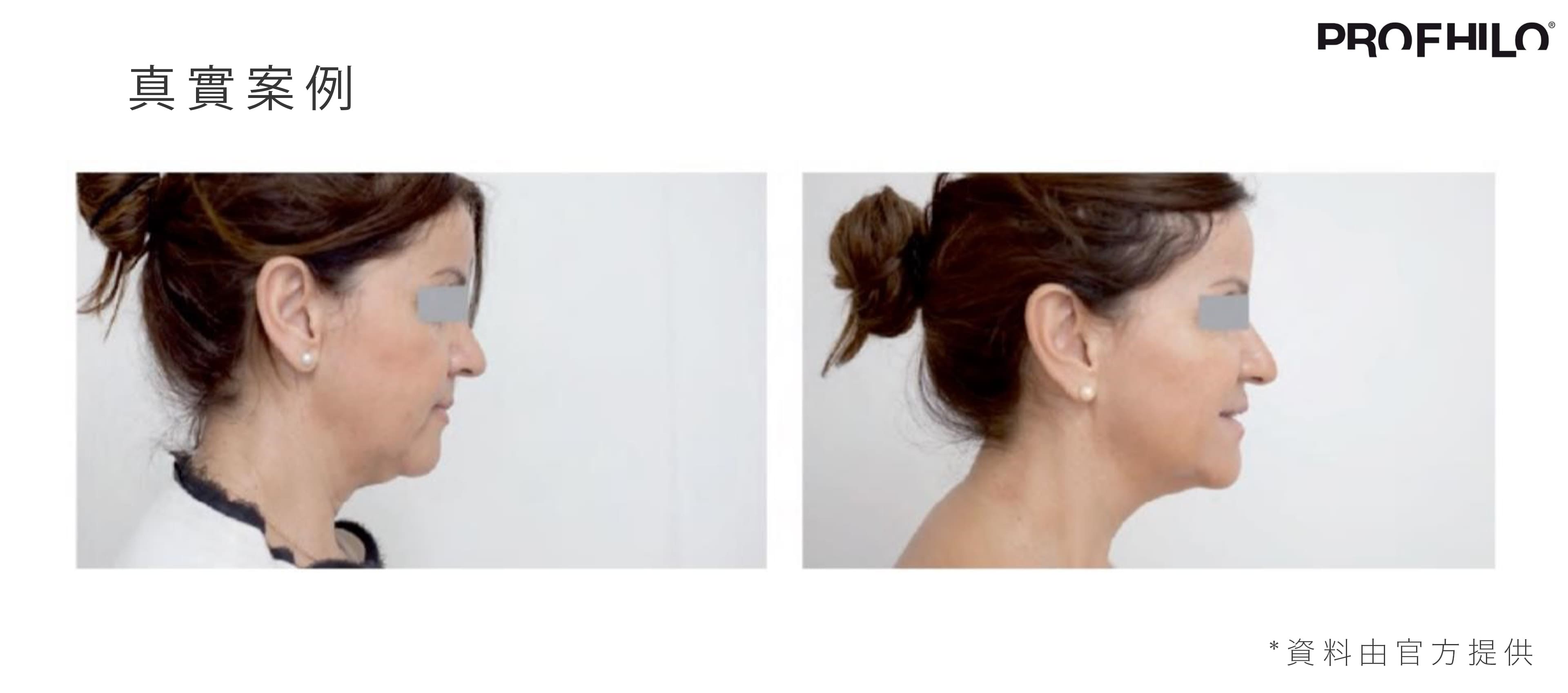 Profhilo 逆時針 | 透明質酸針 | 激活膠原逆轉肌齡 - Medskin Plus